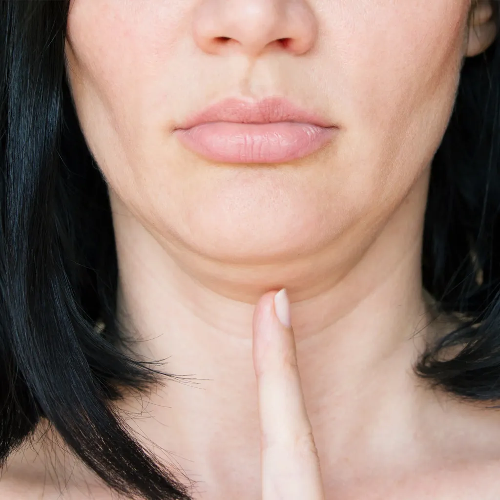 Double Chin Reduction Treatment Clinic in Kolkata | Advanced Double ...